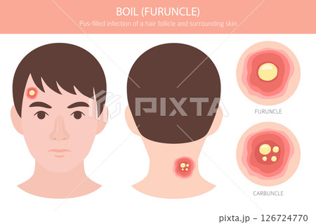 Boil, Furuncle, carbuncle. Skin diseases....のイラスト素材 [126724770] - PIXTA
