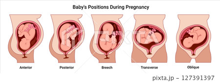 Different baby positions in the uterus during...のイラスト素材 [127391397] - PIXTA