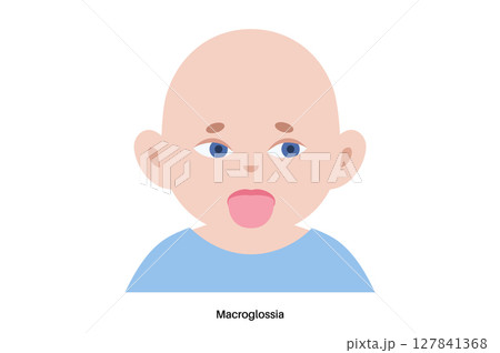 Macroglossia medical posterのイラスト素材 [127841368] - PIXTA