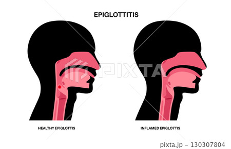 Epiglottitis medical posterのイラスト素材 [130307804] - PIXTA