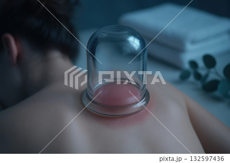 Glass cupping therapy on bare back with visible...のイラスト素材 [132597436 ...