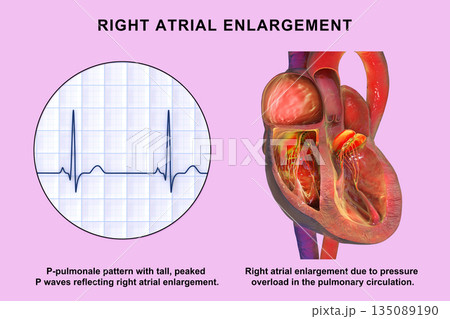 Right atrial enlargement with P-pulmonale, 3D...のイラスト素材 [135089190] - PIXTA