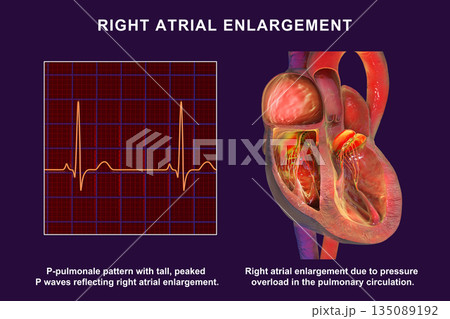 Right atrial enlargement with P-pulmonale, 3D...のイラスト素材 [135089192] - PIXTA